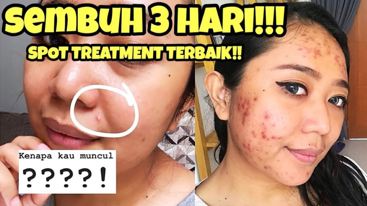 5 Merk Acne Spot Treatment Sesuai Permasalahan Jerawat, dari Bruntusan ...
