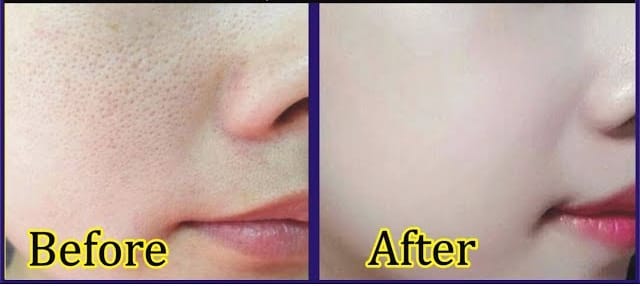 Inilah Cara Cepat Mengecilkan Pori-Pori Wajah dalam 3 Hari, Cukup Pakai Bumbu Dapur Bikin Kulit ...