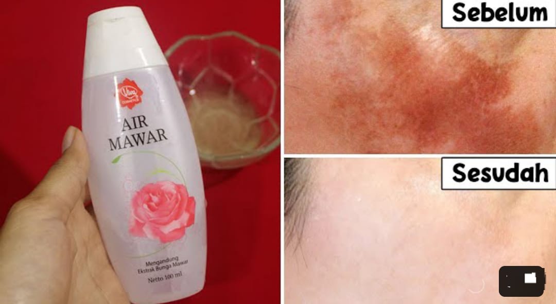 4 Cara Menghilangkan Noda Hitam di Wajah Dengan Air Mawar, Kulit jadi ...